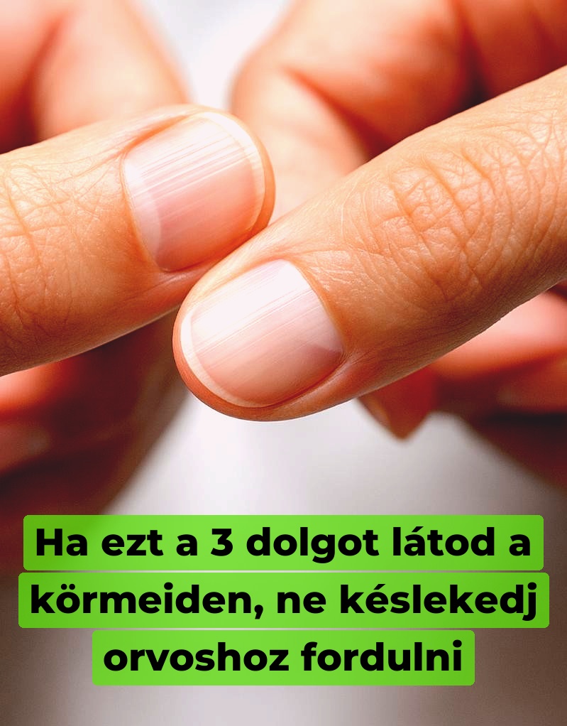 Ha ezt a 3 dolgot látod a körmeiden, ne késlekedj orvoshoz fordulni ...